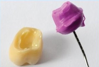Implant Crowns Cementation | Rotsaert Dental Laboratory
