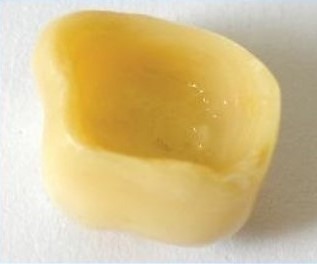 Implant Crowns Cementation | Rotsaert Dental Laboratory