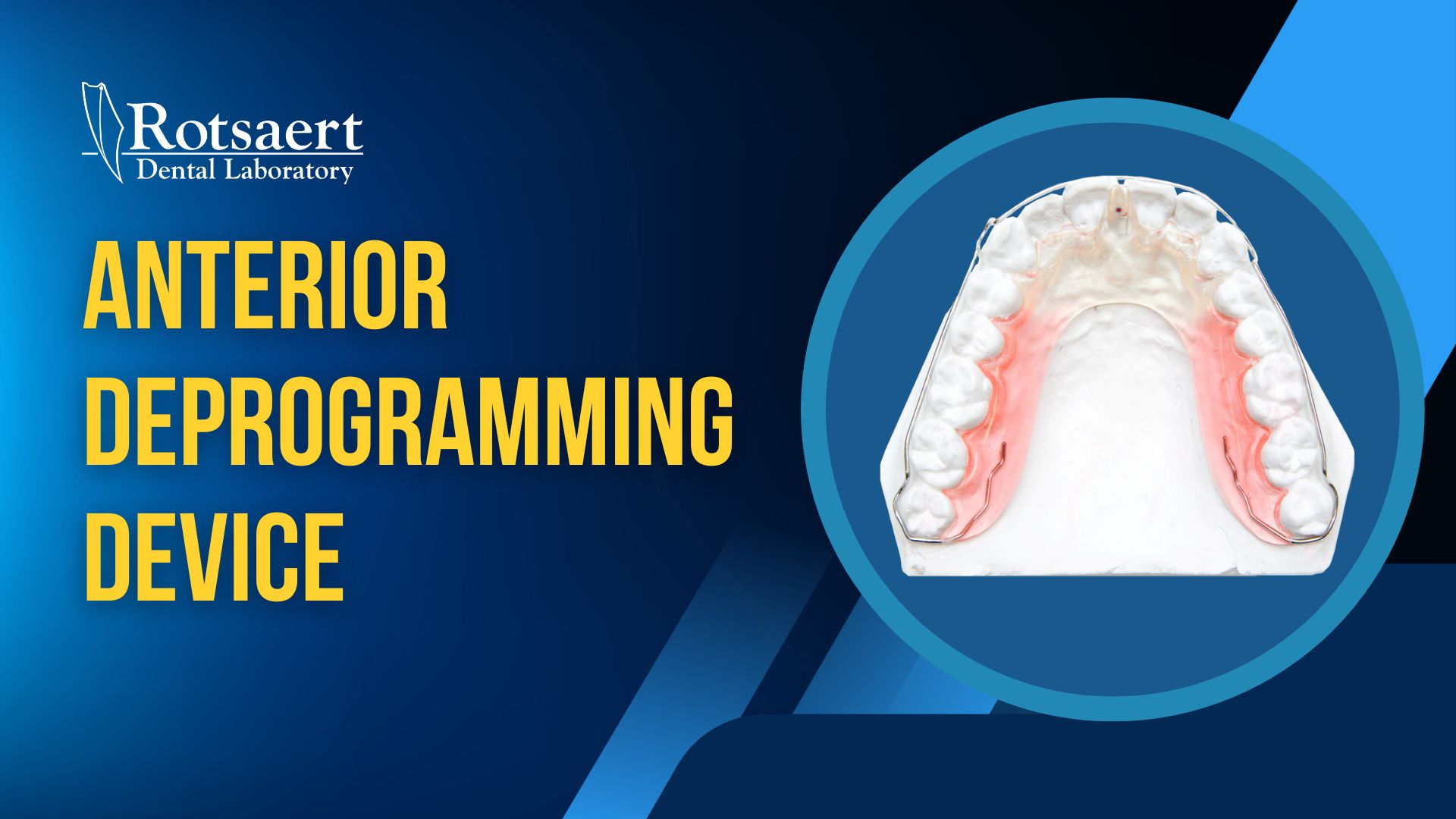 Anterior Deprogramming Device | Rotsaert Dental Laboratory